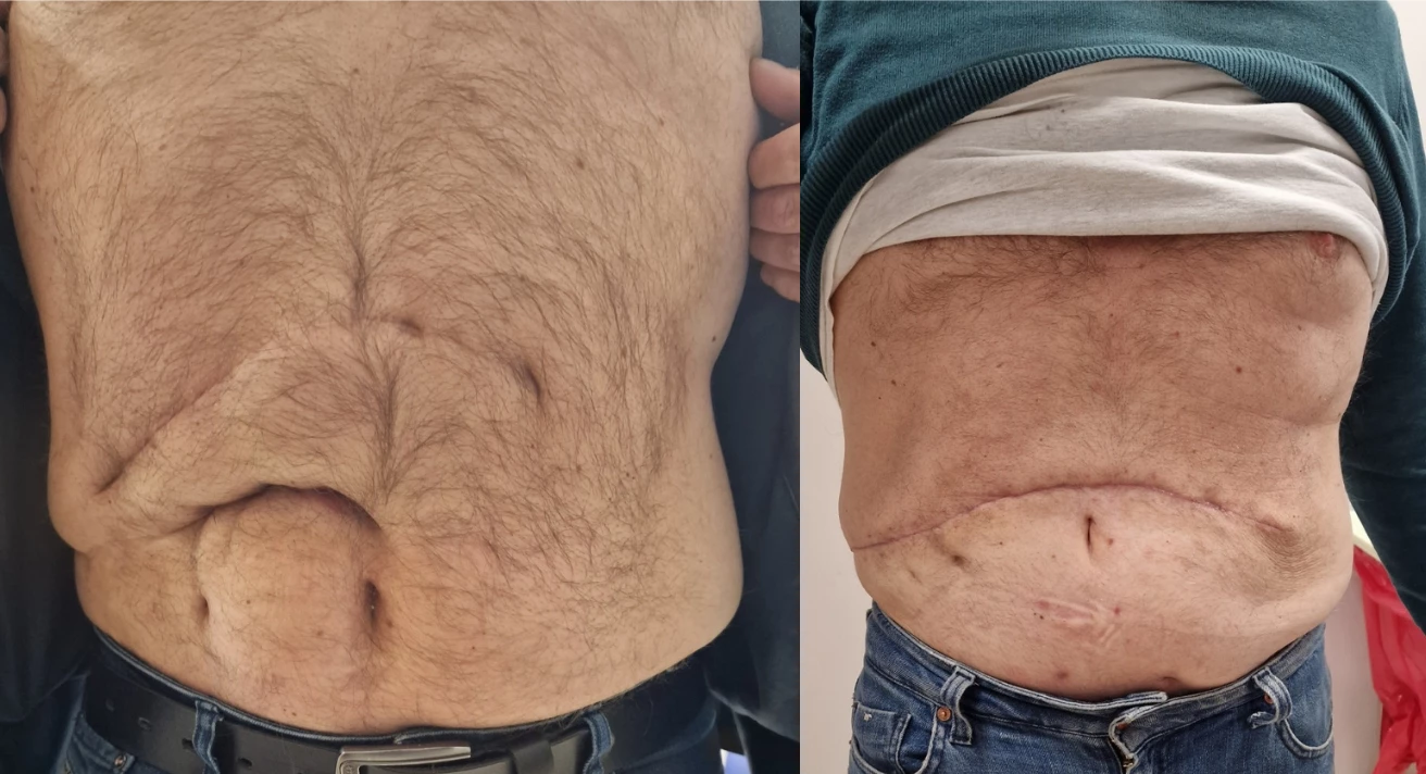 Centrum Leczenia Przepuklin - Przepuklina Pooperacyjna